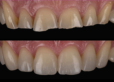 SmileFast Braces Dentist in Bromley - ConfiDental Care